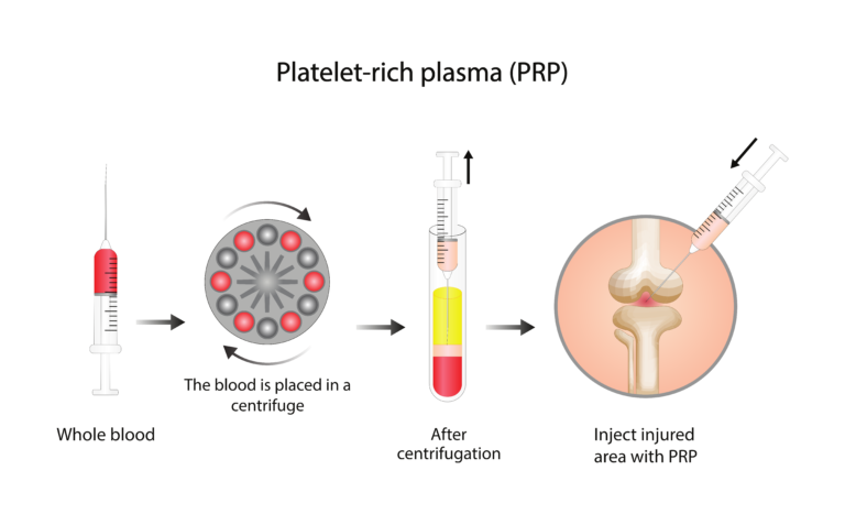 PRP (Platelet-Rich Plasma) Therapy | Florida Joint Care Institute ...